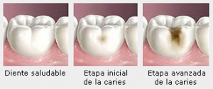 ¿SABES CUALES SON LOS SÍNTOMAS DE LA CARIES DENTAL? – Clínica Dental ...