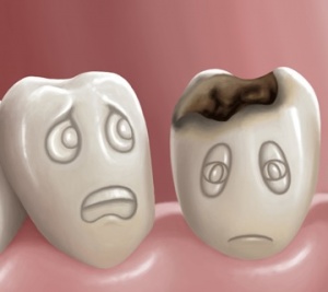 ¿SABES CUALES SON LOS SÍNTOMAS DE LA CARIES DENTAL? – Clínica Dental ...